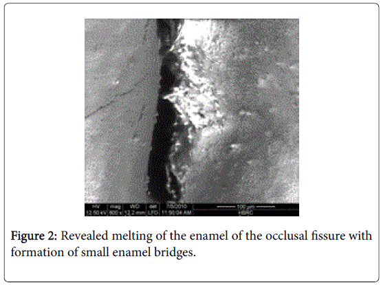 Impact of welding the dental enamel walls of the fissure system using ...