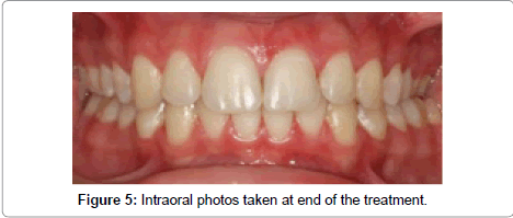 Evaluation Of Dentofacial Changes Caused With Sabbagh Universal Spring ...