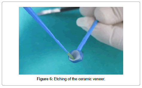 Bonding of all Ceramic Restorations