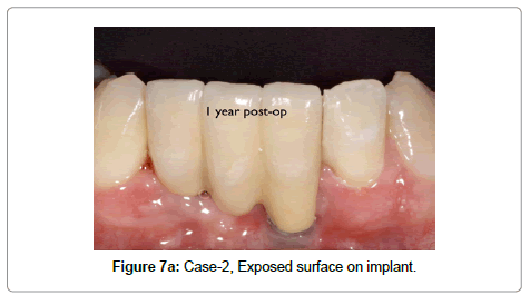 Retrospective on Treating Periimplantitis