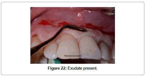 Retrospective on Treating Periimplantitis