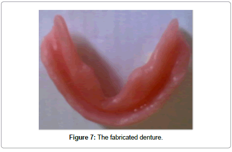 Sublingual Crescent Extension: A Solution for Loose Lower Denture-A ...