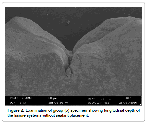 Morphology of Pits and Fissures Reviewed through Scanning Electro