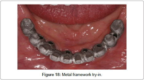 The Use Of Indirect Resin Composites In Clinical Practice: A Case