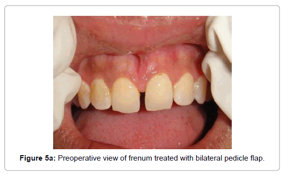 Comparative Results Of Frenectomy By Three Surgical Techniques ...