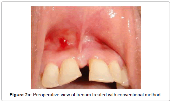 Comparative Results Of Frenectomy By Three Surgical Techniques ...