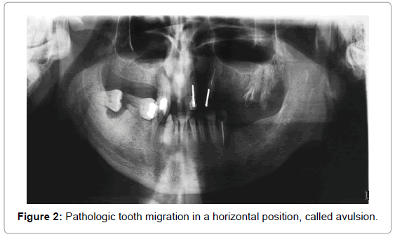Introducing a new type of pathologic tooth migration in a patient