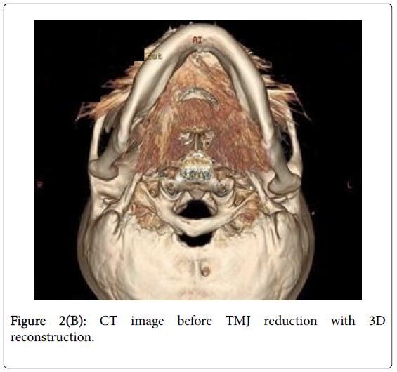 An Unusual Masticator Space Infection Initially Presenting as ...