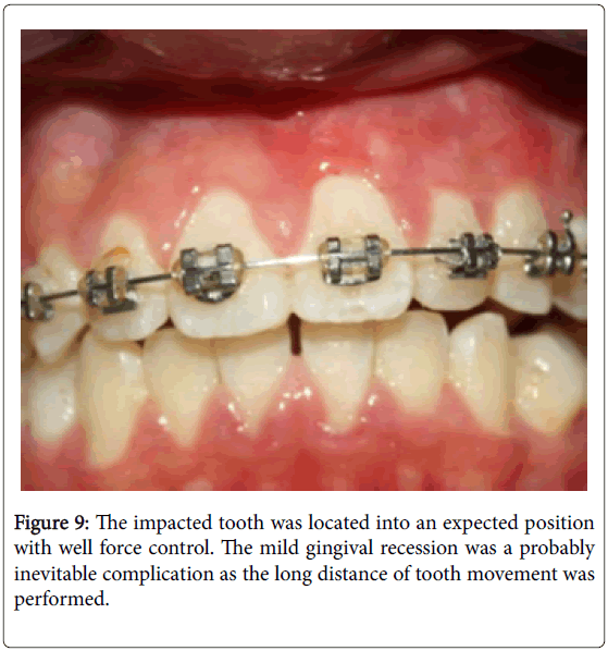 Orthodontic and Surgical Treatment in an Inverted Maxillary Impacted ...