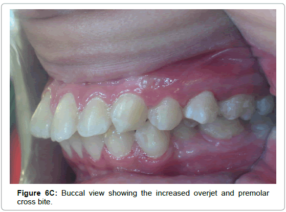 The Amalgamated Technique
