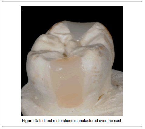 Microleakage Of Composite Inlays Luted With Self-Adhesive Cements