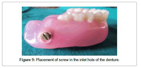 Cheek Plumper with a Salivary Reservoir: An Esthetic and Function