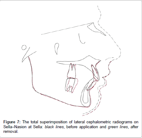 Evaluation Of Dentofacial Changes Caused With Sabbagh Universal Spring ...