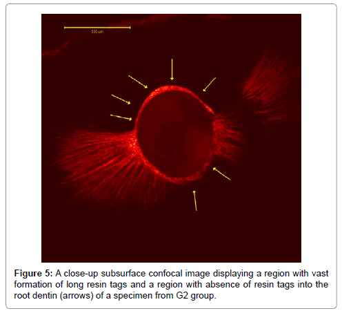 Resin Tags Have No Contribution On Push-Out Bond Strength Of Self ...