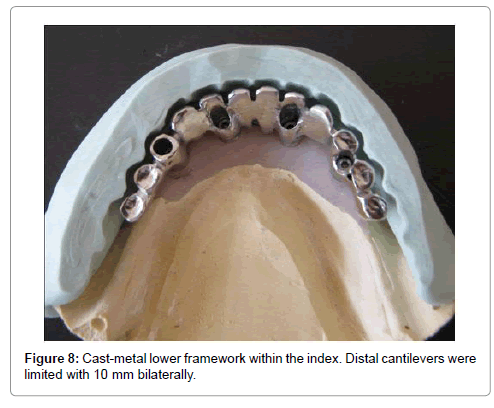 Mock-Up Driven Designing Of Full-Mouth Implant-Supported Metal-Ceramic ...