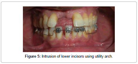 Orthodontic Management of Periodontally Compromised Diabetic Indi