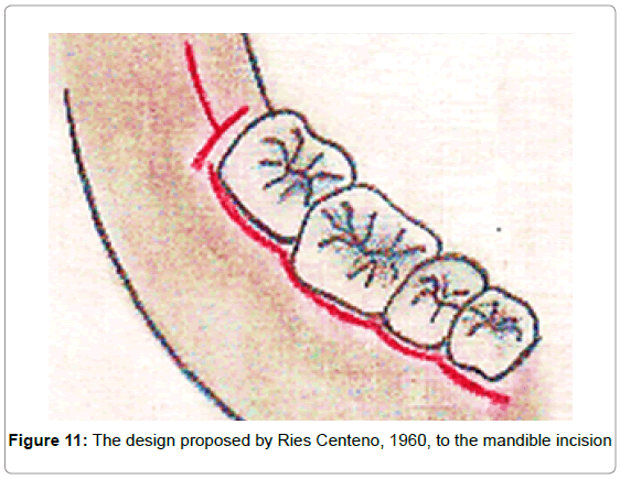 The Different Types of Flaps in the Surgical Relations of the Third ...