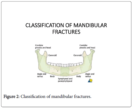 Use of Mandibulo-Maxillary Fixation Screws for the Treatment of M