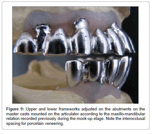 Mock-Up Driven Designing Of Full-Mouth Implant-Supported Metal-Ceramic ...