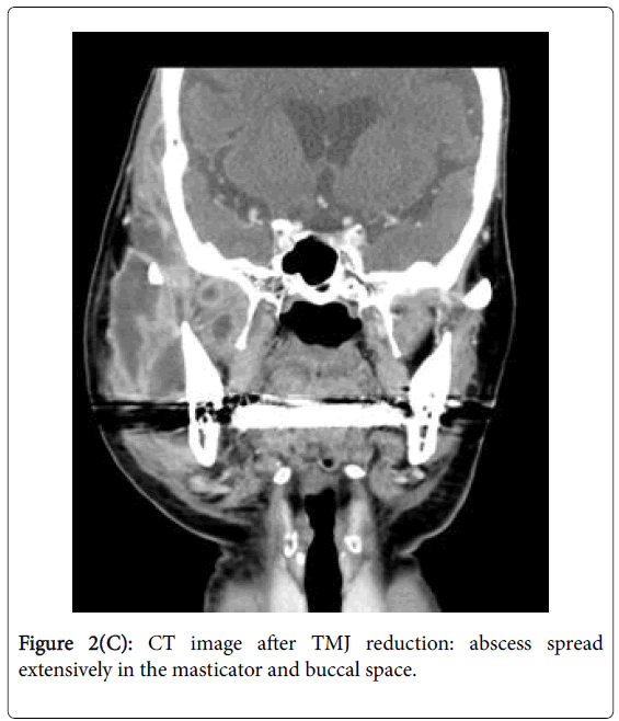 An Unusual Masticator Space Infection Initially Presenting as ...