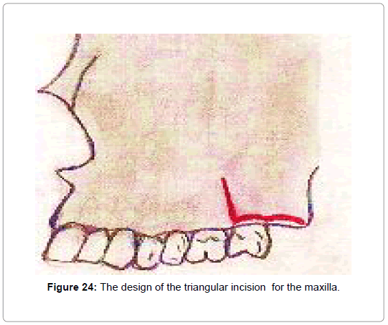 The Different Types of Flaps in the Surgical Relations of the Third ...
