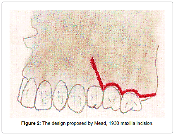 The Different Types of Flaps in the Surgical Relations of the Third ...