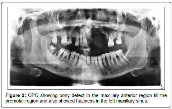 Maxillary Osteomyelitis by Mucormycosis: A Case Report and Litera
