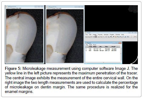 Microleakage Of Composite Inlays Luted With Self-Adhesive Cements
