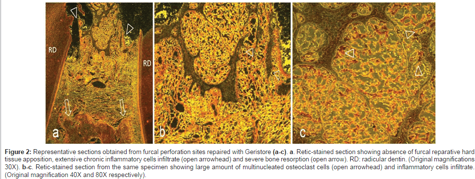 Histological Examination of Furcal Perforation Repair Using Geristore ...