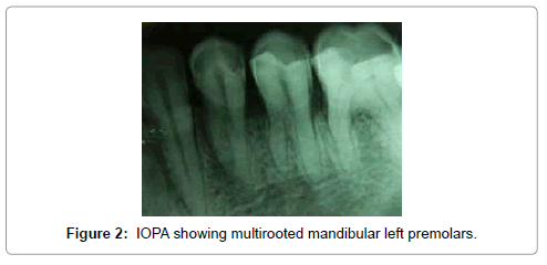 Multirooted- Bilateral Maxillary and Mandibular First and Second ...