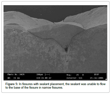 Morphology of Pits and Fissures Reviewed through Scanning Electro