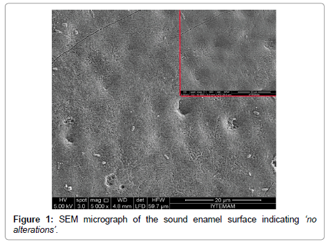 Scanning Electron Microscopy Investigation Of Enamel Surface Treated ...