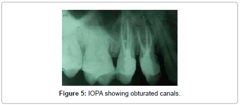 Multirooted- Bilateral Maxillary and Mandibular First and Second ...