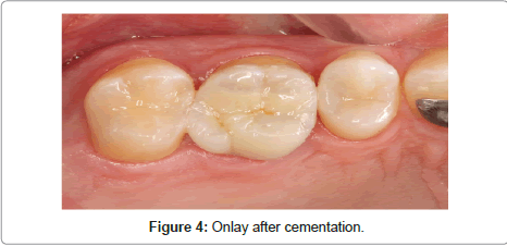 The Use Of Indirect Resin Composites In Clinical Practice: A Case