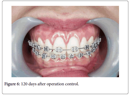 Esthetic Crown Lengthening with Flapless Osseous Reduction using