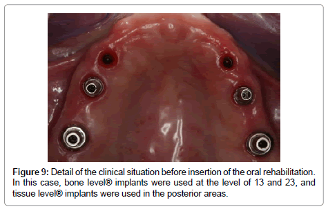 The Edentulous Maxillary Arch: A Novel Approach To Prosthetic ...