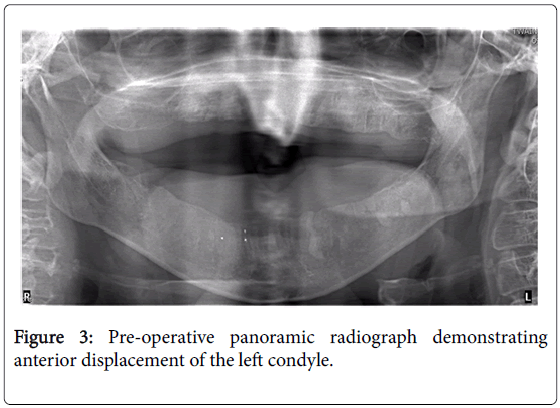 Surgical Management of Chronic and Refractory TMJ Dislocation in