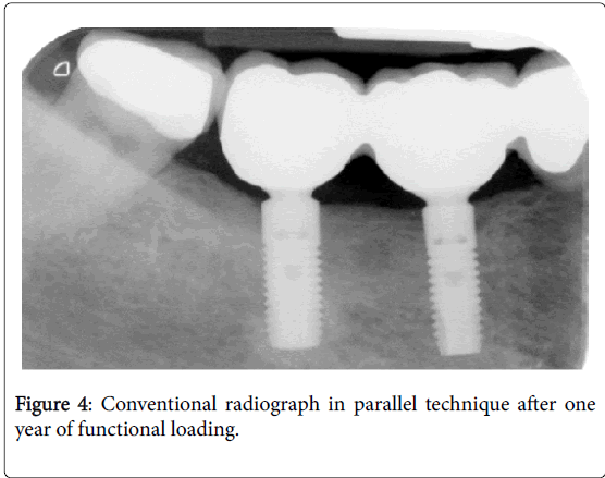 Retrospective Analysis of Biological and Technical Complications