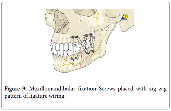 Use of Mandibulo-Maxillary Fixation Screws for the Treatment of ...