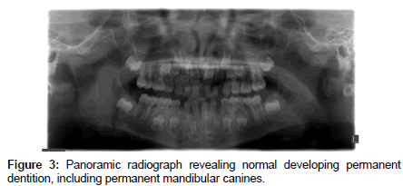 Congenital Bilateral Missing Primary Mandibular Canines While The