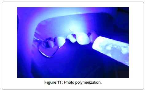 Bonding of all Ceramic Restorations