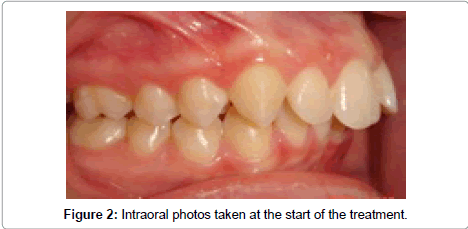 Evaluation Of Dentofacial Changes Caused With Sabbagh Universal Spring ...