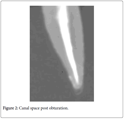 Evaluation Of Three Different Obturation Techniques Using Three-D