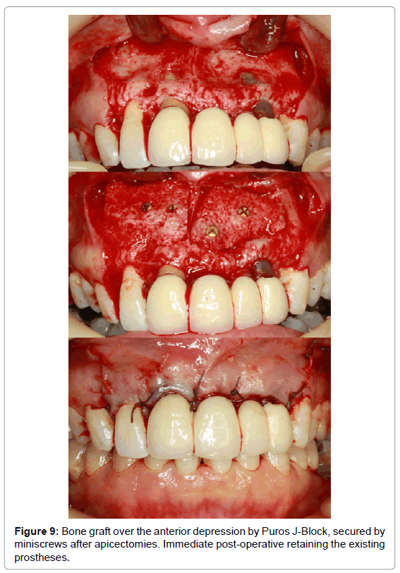 Socket Transformation: A Feasible Alternative before Immediate Im