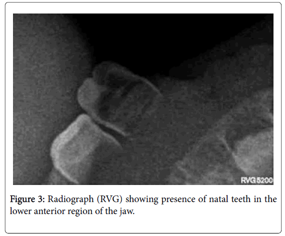 Natal Tooth-An Overview and A Case Report