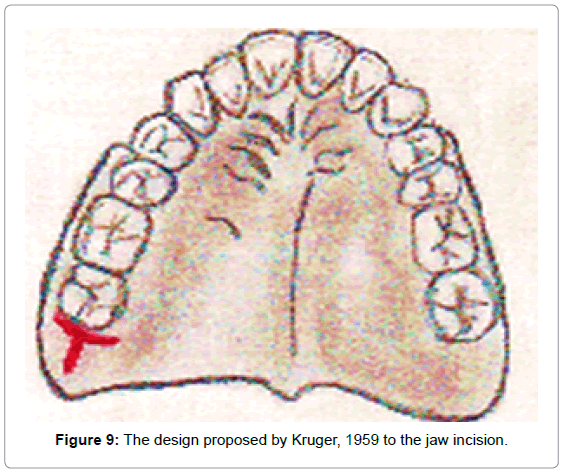 The Different Types of Flaps in the Surgical Relations of the Third ...