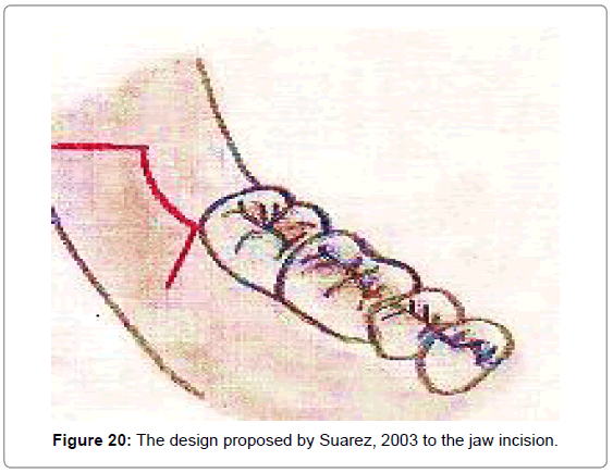 The Different Types of Flaps in the Surgical Relations of the Third ...