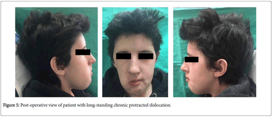 Surgical Management of Chronic and Refractory TMJ Dislocation in