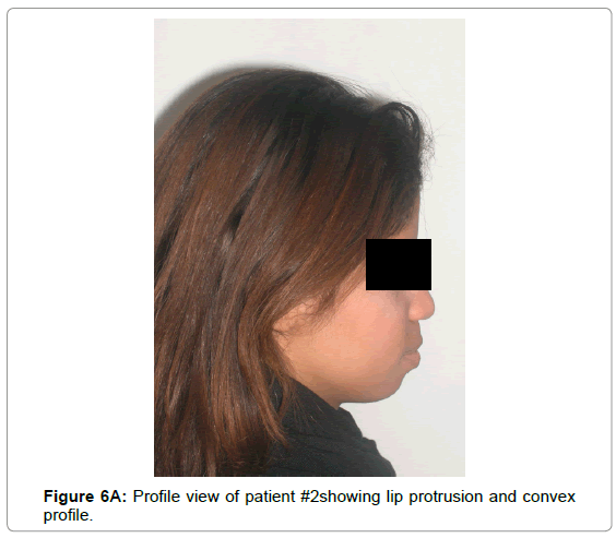 The Amalgamated Technique