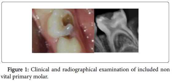 A New Era in Treatment of Non - Vital Primary Molars: One Year Fo
